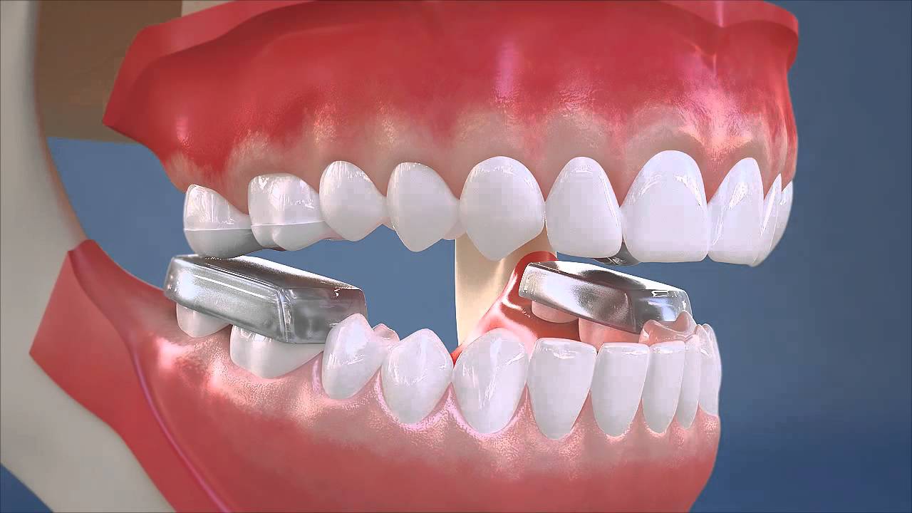 Răng cắn mở và phương pháp điều trị – Nha Khoa Thế Giới Đẹp